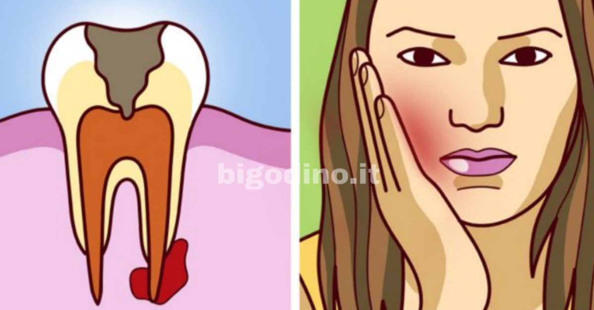 Ascesso dentale, come riconoscerlo e curarlo Ascesso dentale, come riconoscerlo e curarlo